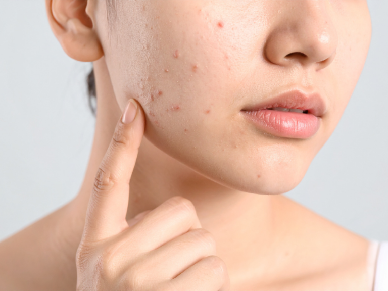 DIY Natural Acne Treatments That Actually Work